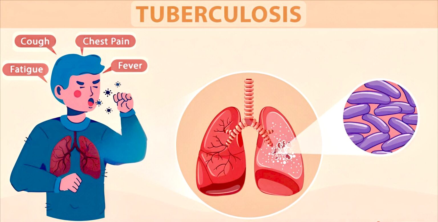 How to Recognize Tuberculosis (TB) Symptoms and Get the Right Treatment ...